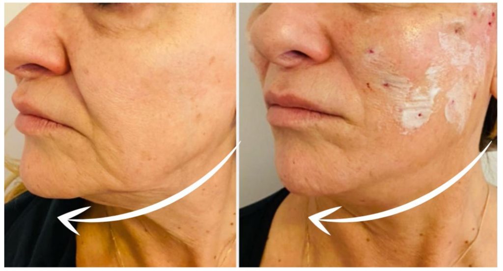 Redefining Beauty The Artistry of Non Surgical Face Lifts