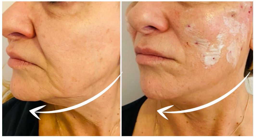Redefining Beauty The Artistry of Non Surgical Face Lifts